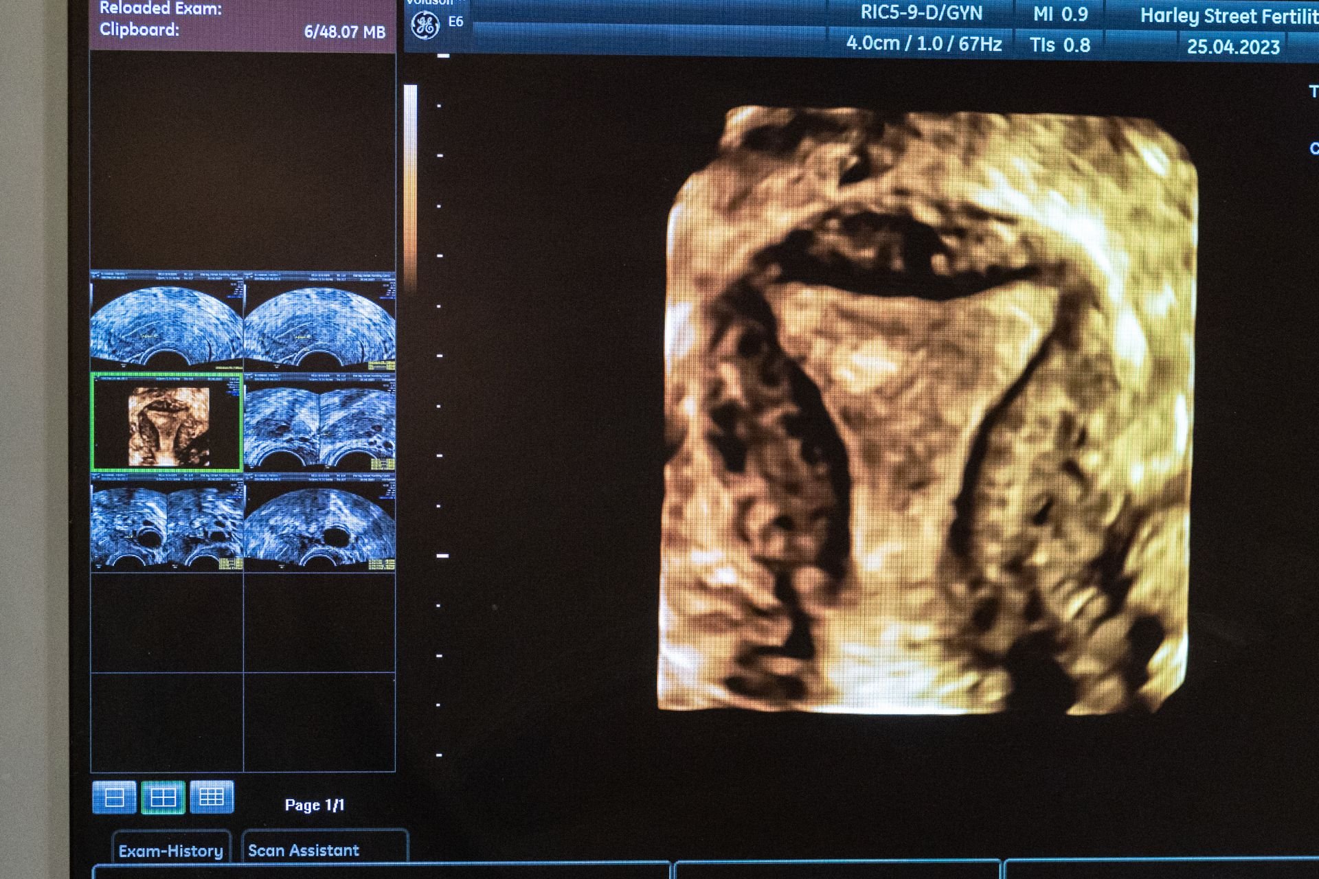 Saline infusion sonohysterogram treatment to enhance implantation in IVF